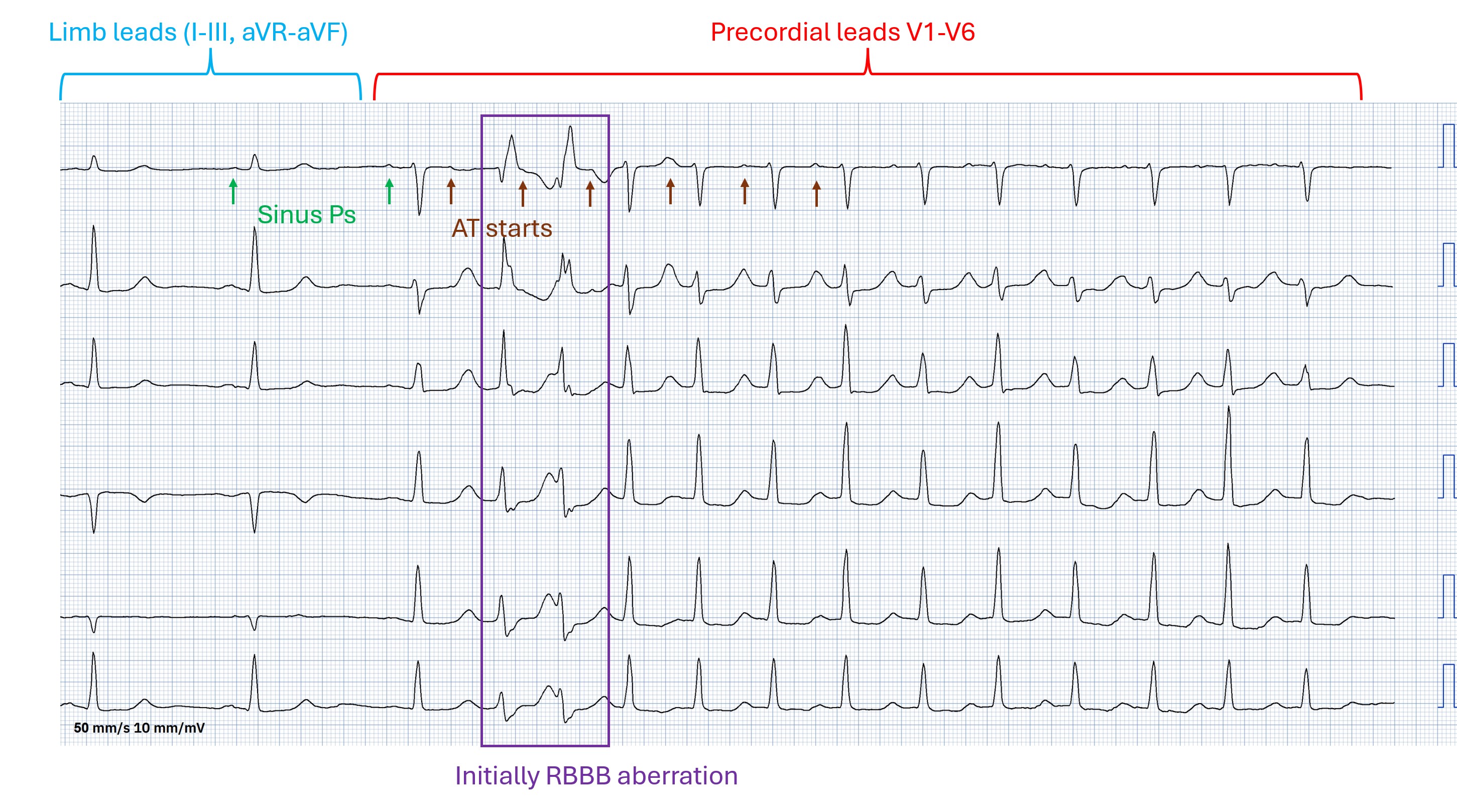 Aberrant conduction | ECG Guru - Instructor Resources